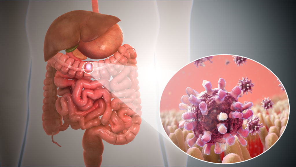 GASTROENTERITIS OCEAS