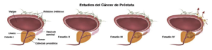 CÁNCER DE PRÓSTATA – OCEAS